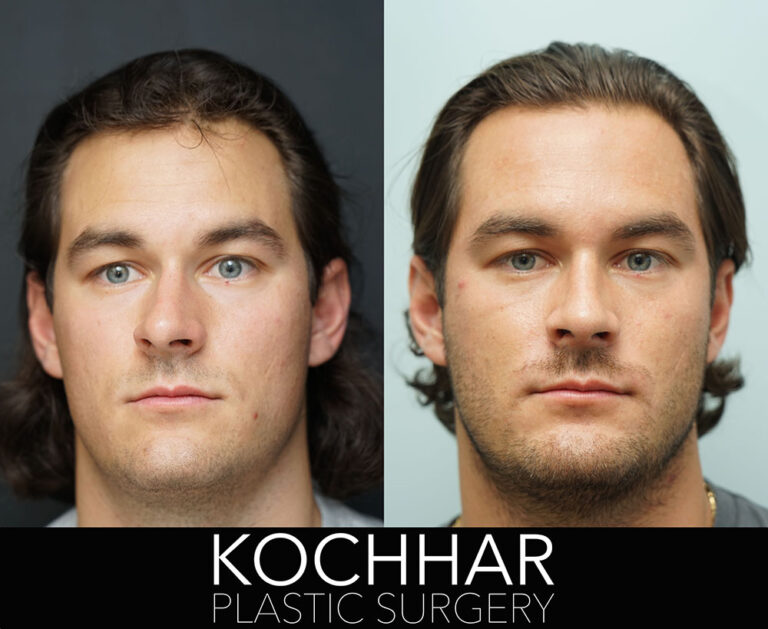 FACIAL TRAUMA & SCAR RECONSTRUCTION - Kochhar Plastic Surgery