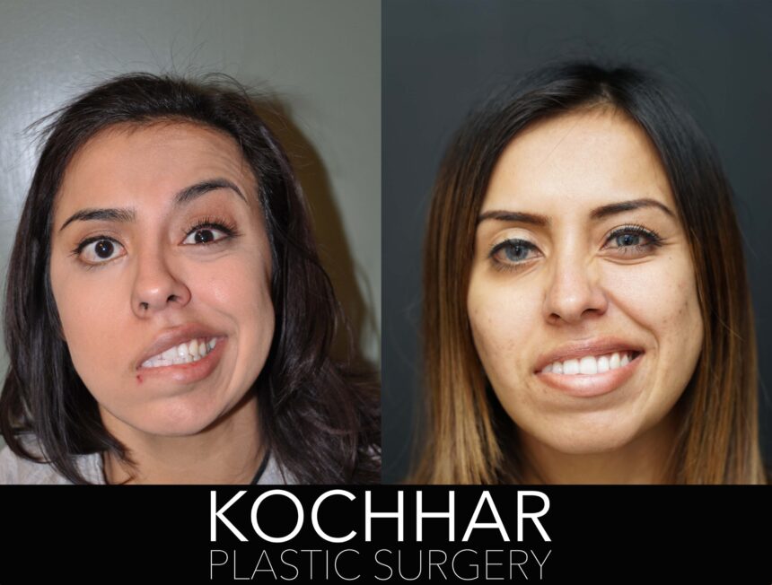 FACIAL TRAUMA & SCAR RECONSTRUCTION - Kochhar Plastic Surgery