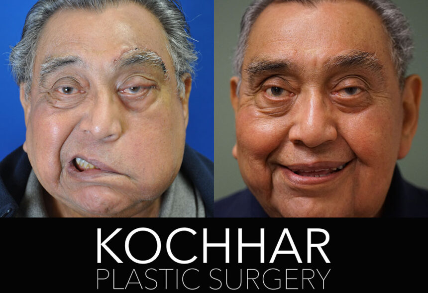 FACIAL TRAUMA & SCAR RECONSTRUCTION - Kochhar Plastic Surgery